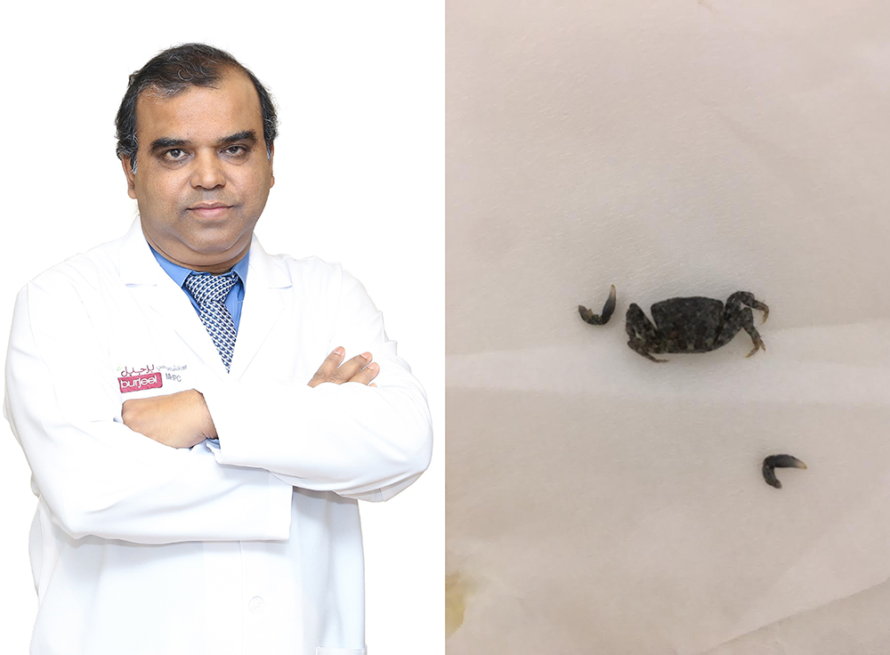 Doctor takes out a baby crab from man’s ear in UAE - https://www ...